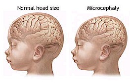 Microcephaly is obviously a serious condition, but it does only one ...